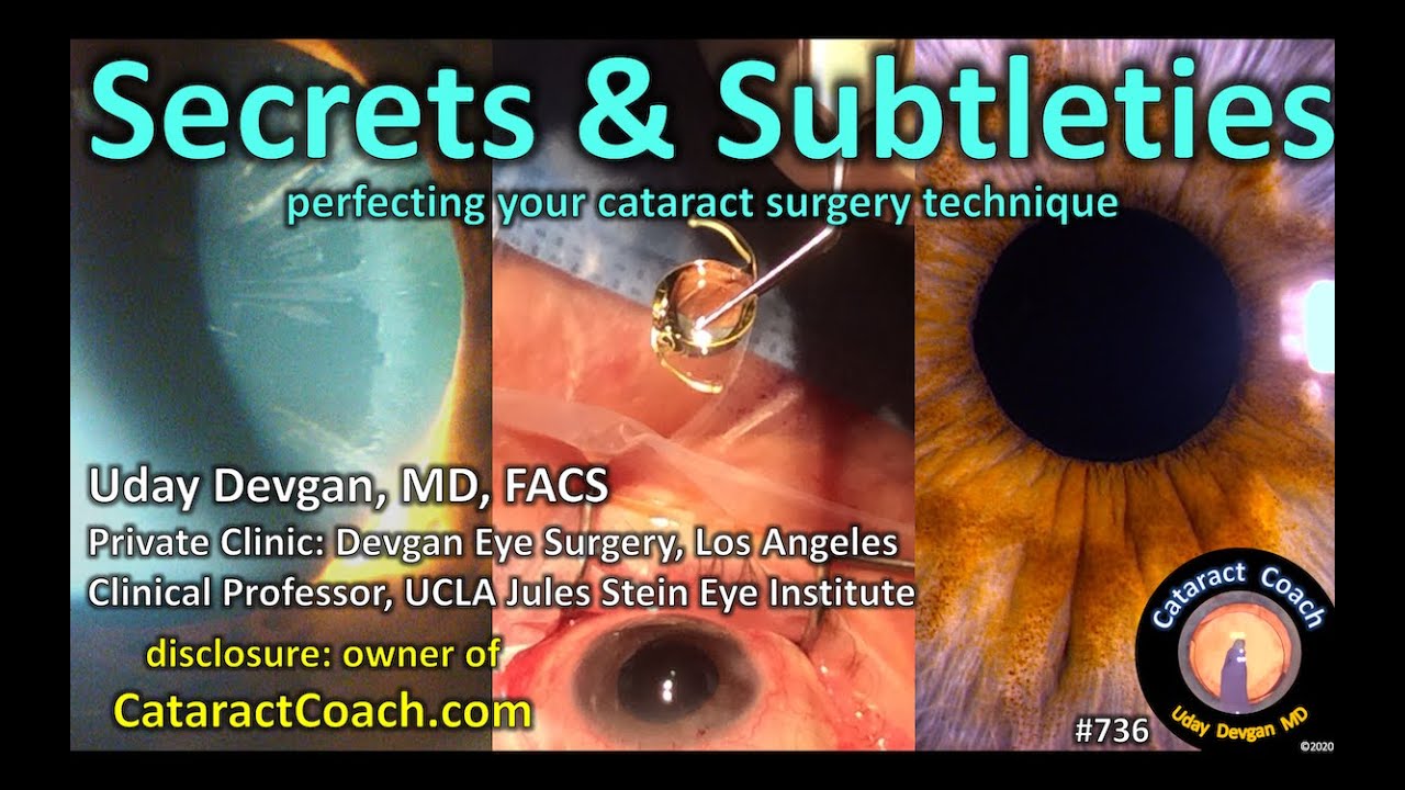 compilation video: secrets and subtleties to perfecting your cataract ...