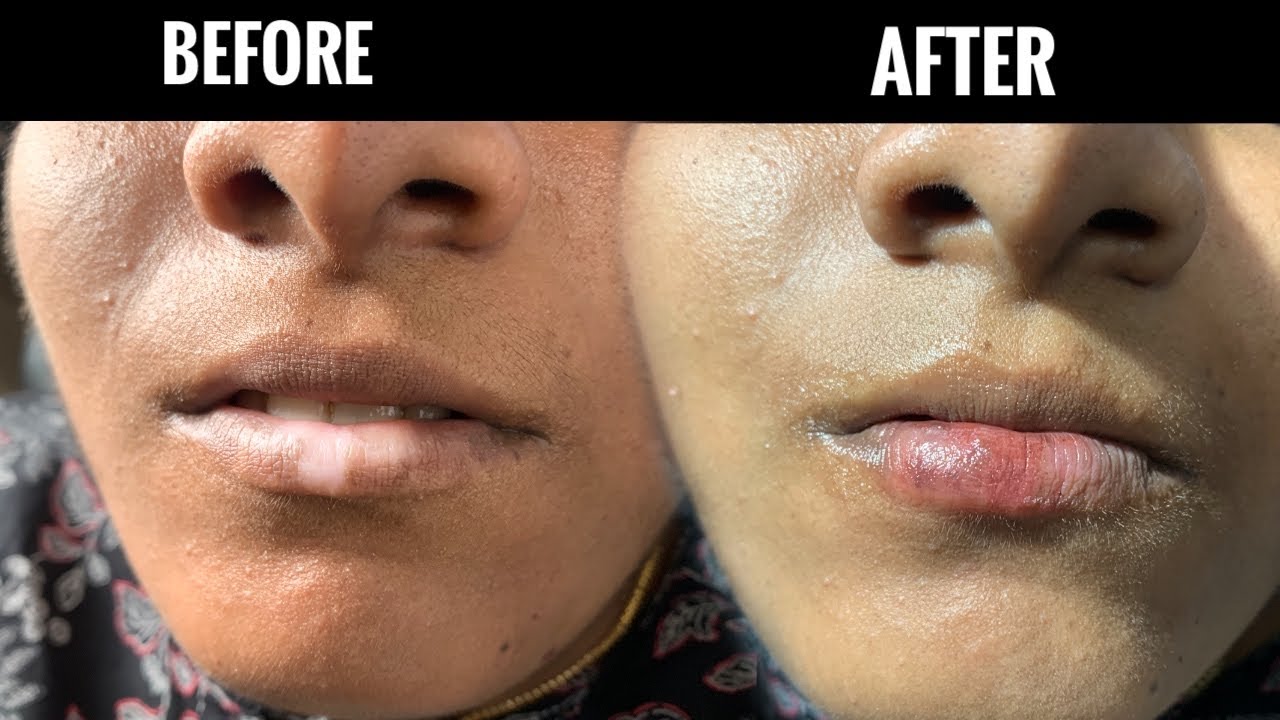 How to change dark lips into lighter natural lip color ? +91 9659959593 ...
