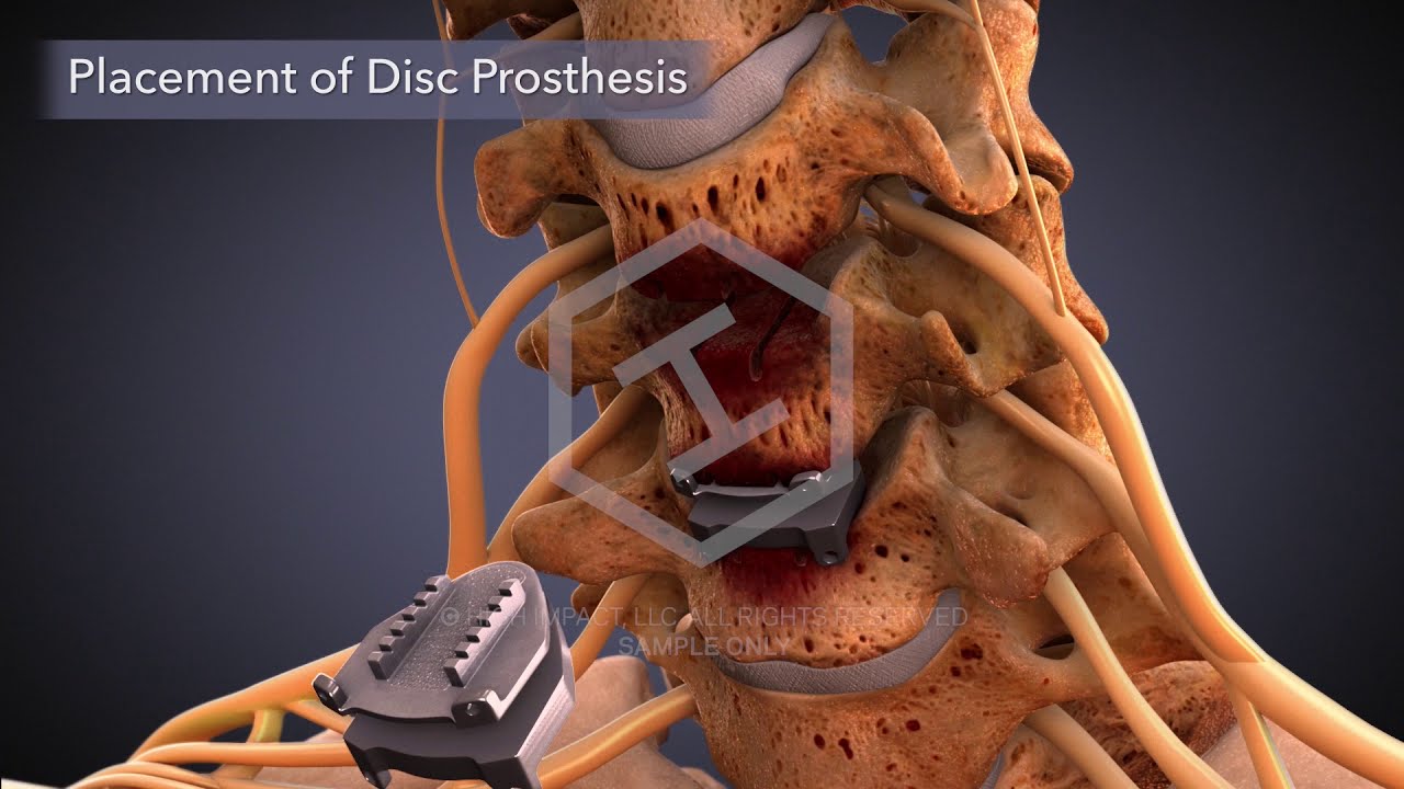 $2.25M Settlement on $8,700 Offer: Animating Cervical Disc Replacement ...