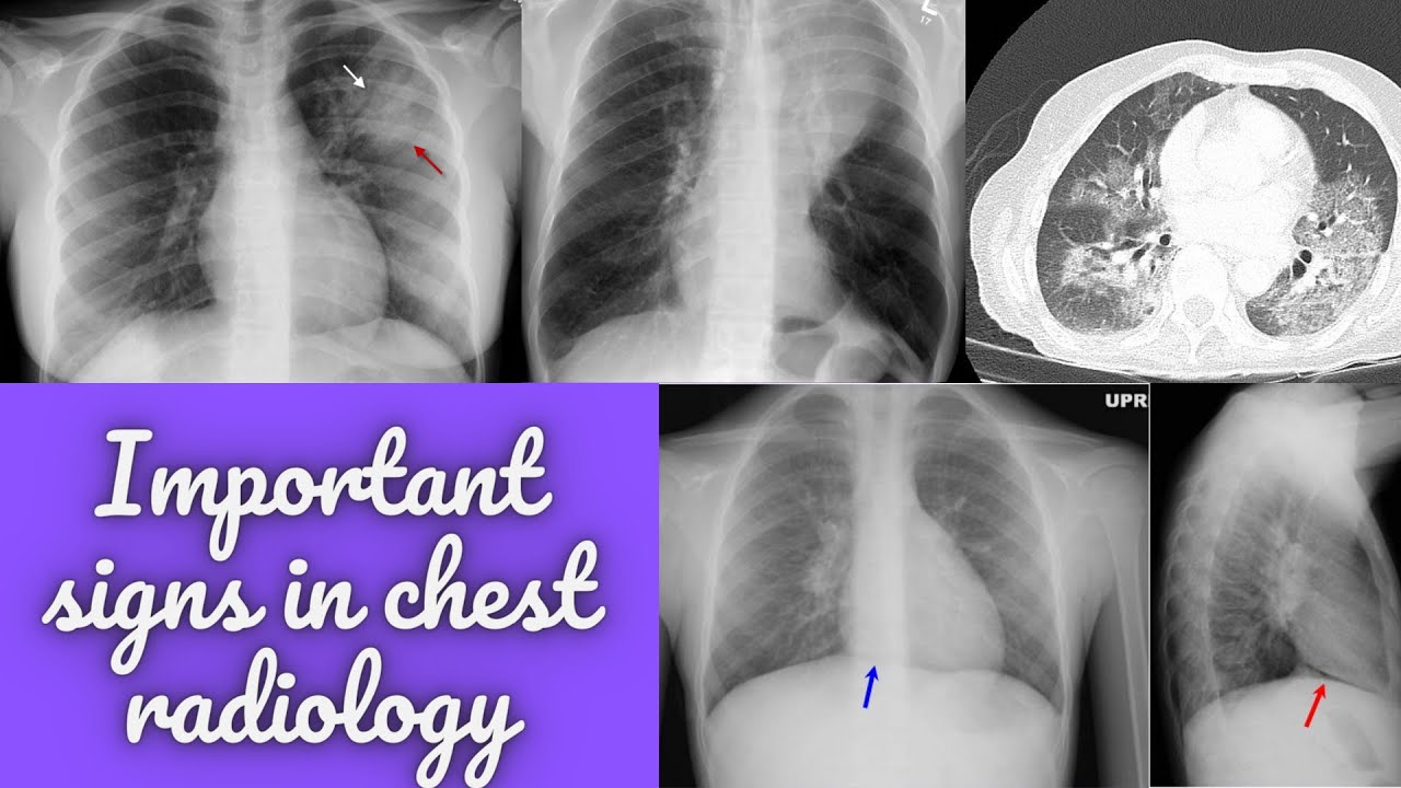 Important signs in chest radiology | NEET PG | Dr. Himanshu Gupta - YouTube