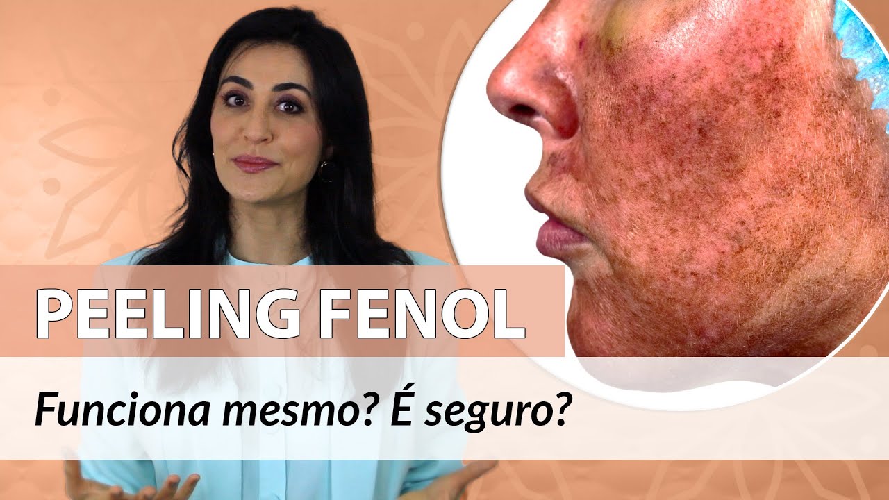 Peeling de Fenol: realmente funciona para rejuvenescer a pele? É ...