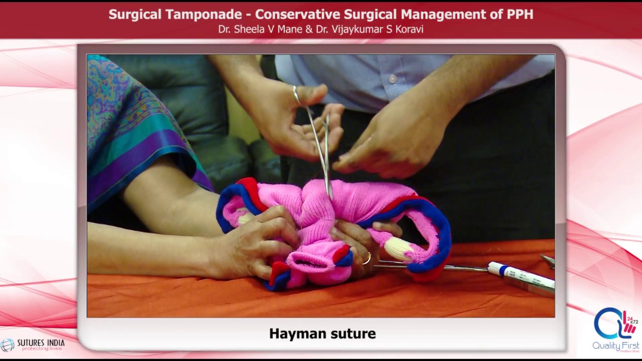 Surgical Management of PPH by Dr. Sheela Mane - YouTube