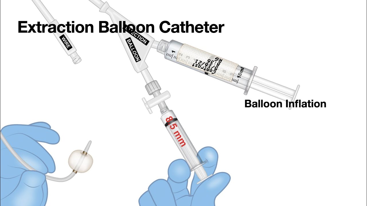 HCC 1474 -13 Extraction balloon catheter movie - YouTube