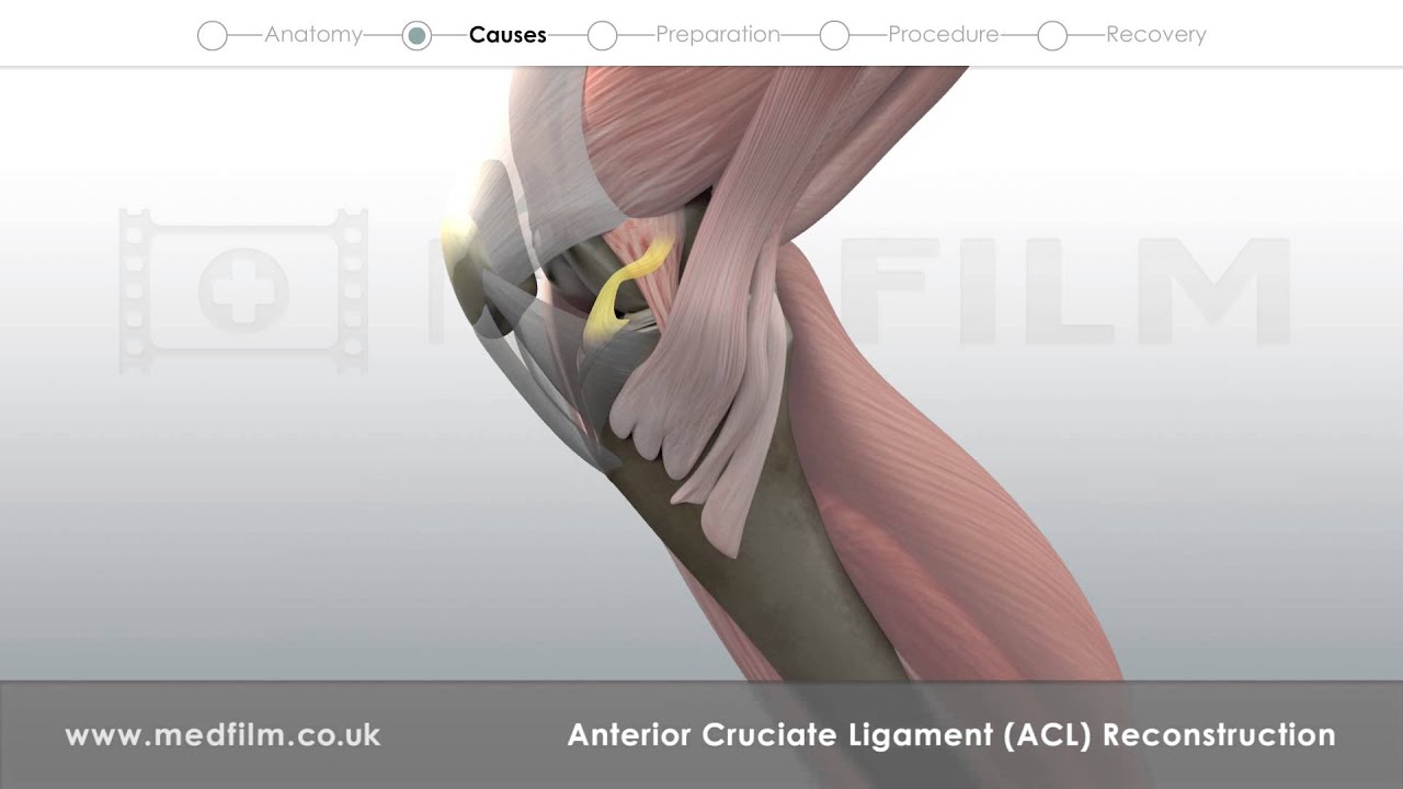 Patient Film: ACL Reconstruction - YouTube