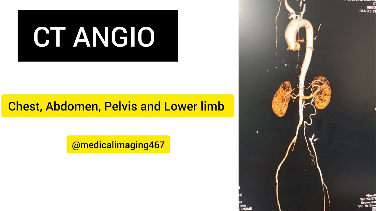 CT Angiography|CAP and Lower limb| Aortogram| - YouTube
