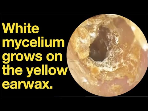 White mycelium grows on the yellow earwax.|ear wax removal | ear ...