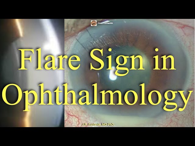 Anterior Uveitis Flare Cells