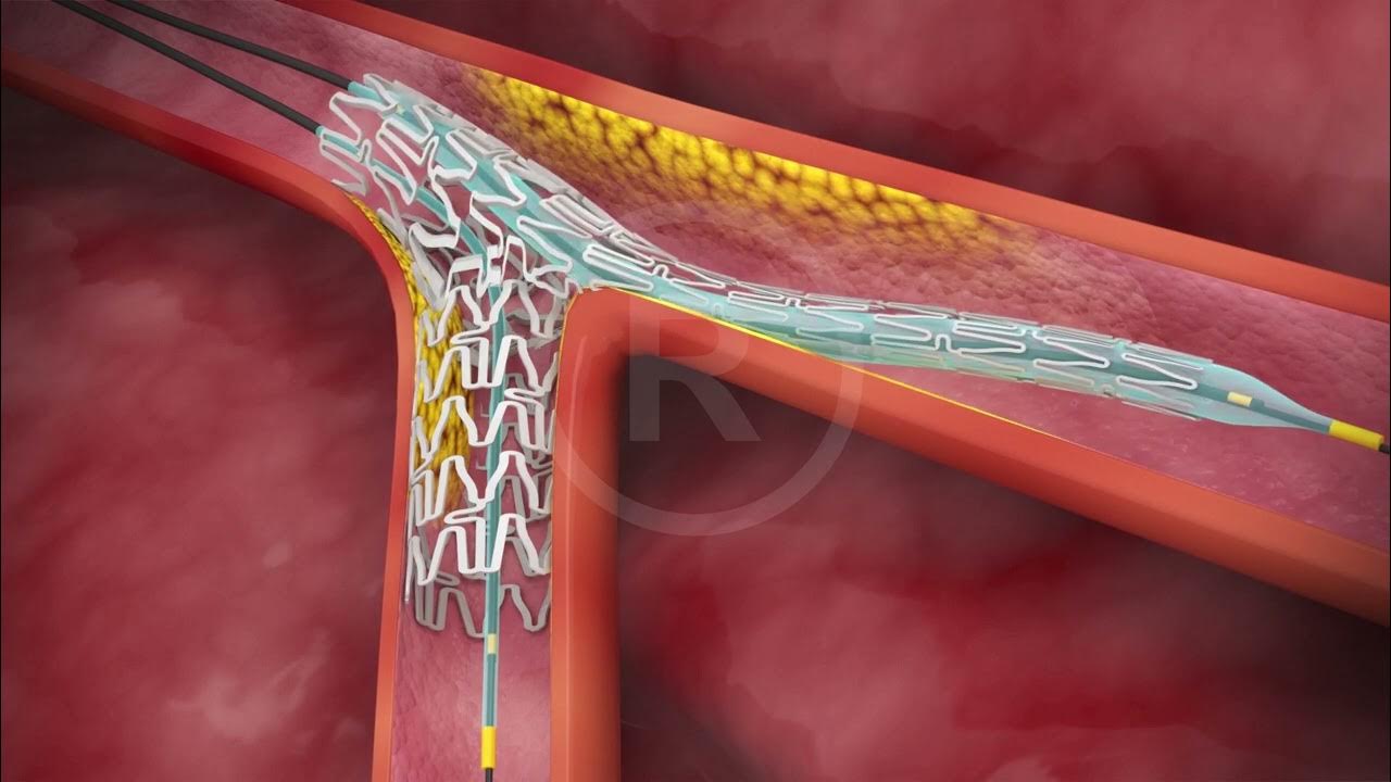 Heart Full Bifurcation Stent Animation WM - YouTube