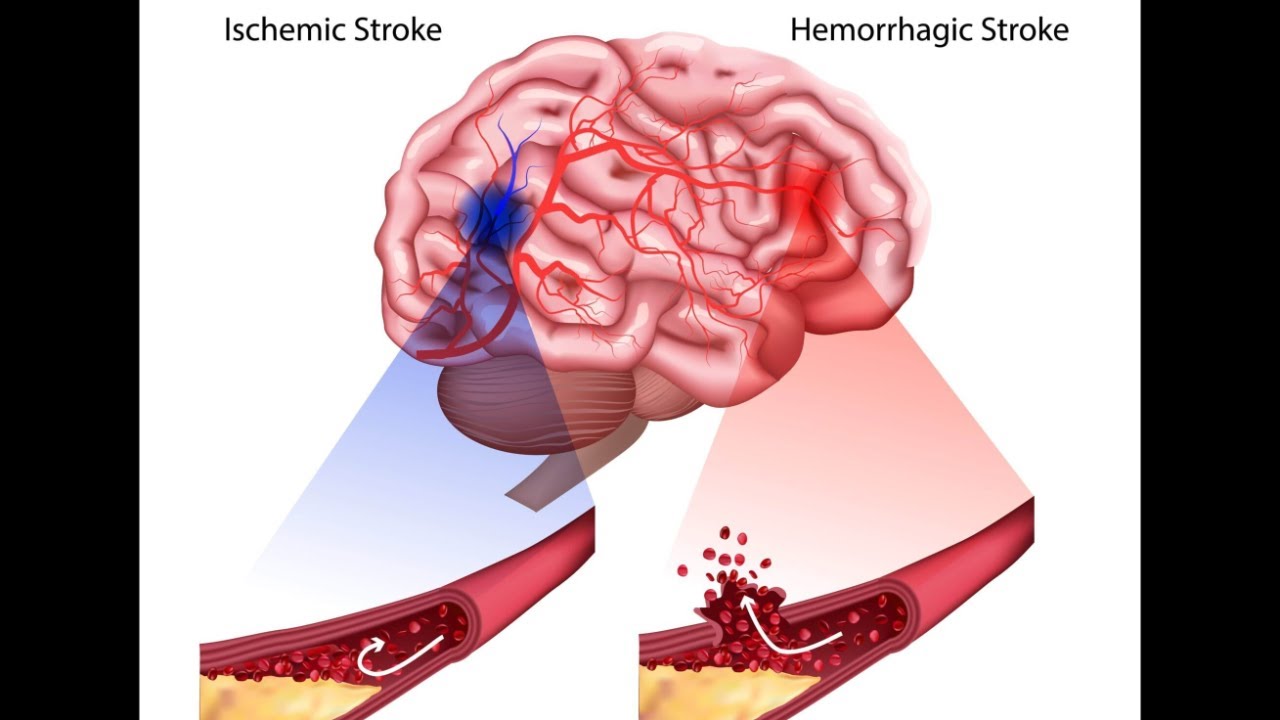 Understanding Stroke Causes Symptoms And Recovery Youtube