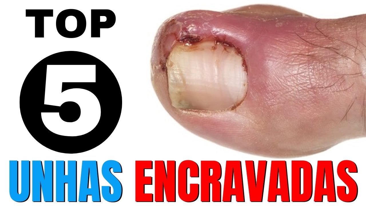 UNHA ENCRAVADA | Top 5 Unhas Encravadas #podologia - YouTube