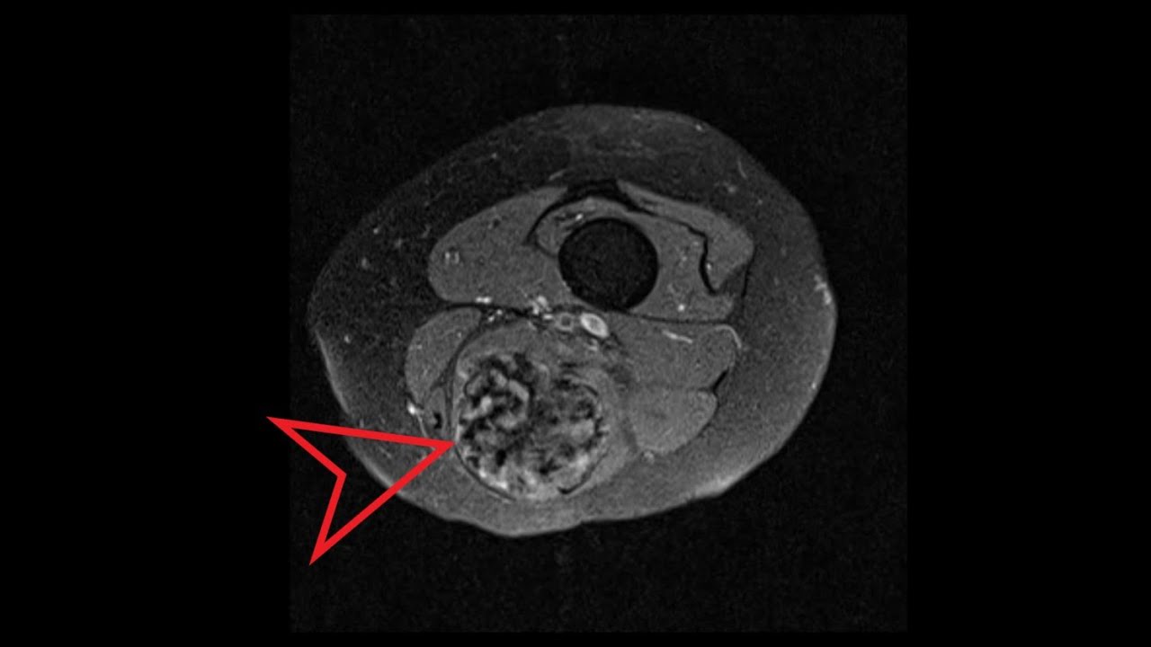 Knee MRI: Knee Mass (Tumor) - YouTube