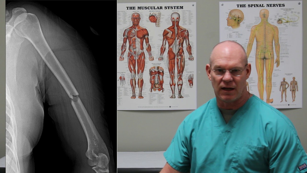Mid-Shaft Humerus Fracture | Episode 30 - YouTube