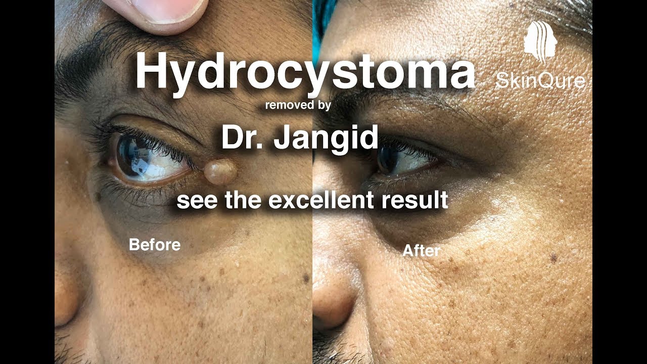 Hidrocystoma removed at SkinQure - YouTube