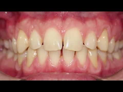 DSD FIRSTFIT VENEERS TECH AND CLINICAL - YouTube