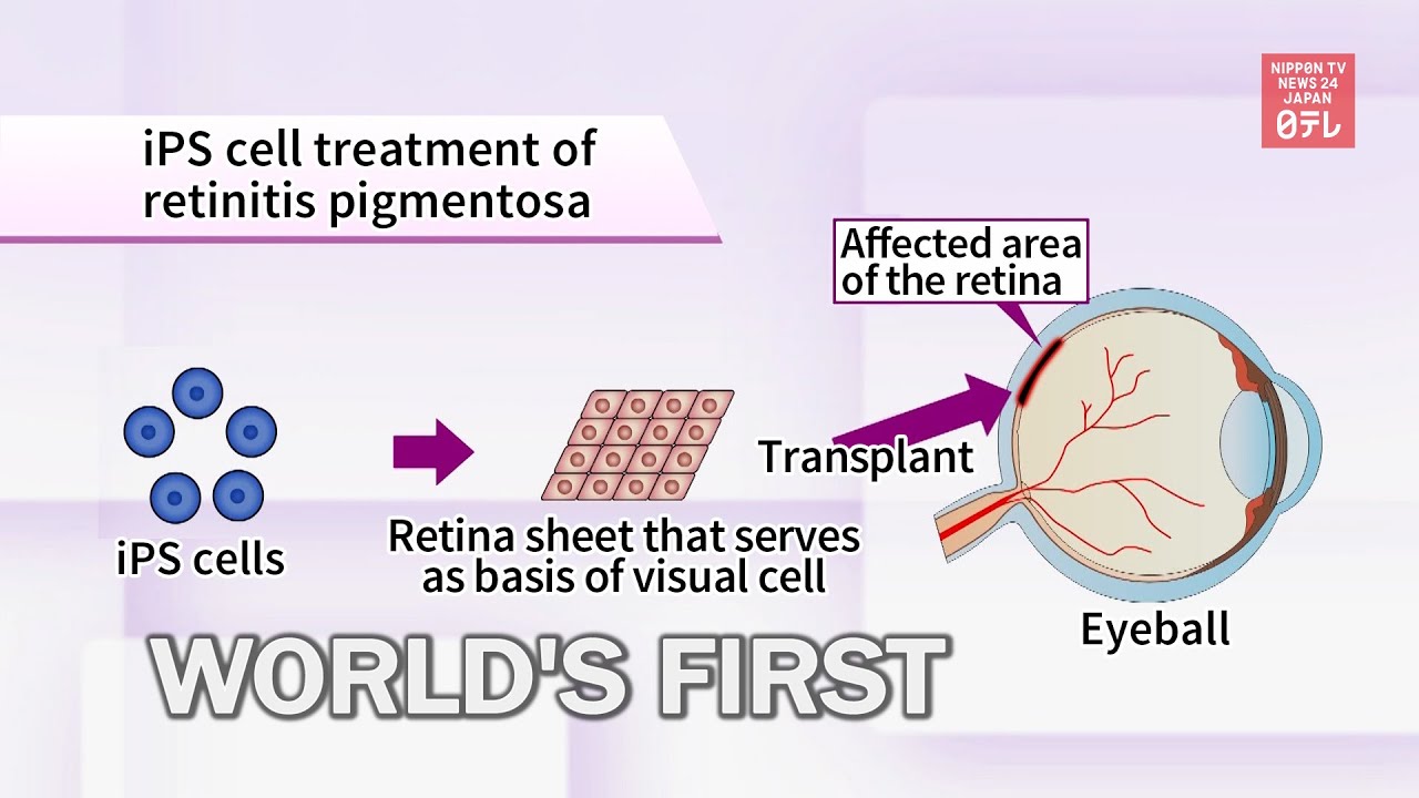 World’s first transplant of iPS derived retinal sheet in Japan - YouTube