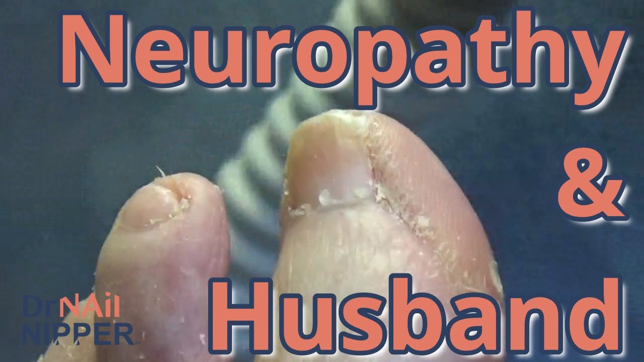 How to treat neuropathy? Dr Nail Nipper and patient talk about her ...