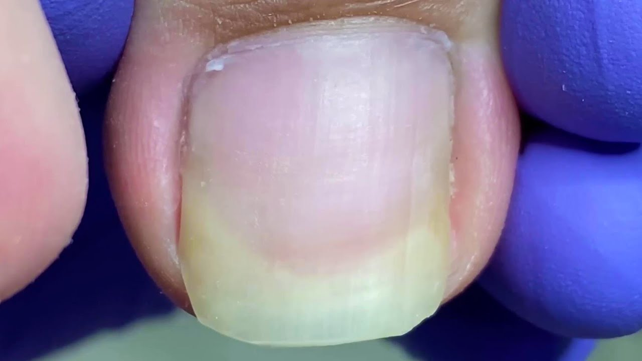 Too long nails are prone to paronychia, prevent deformation!【Doctor Liu ...