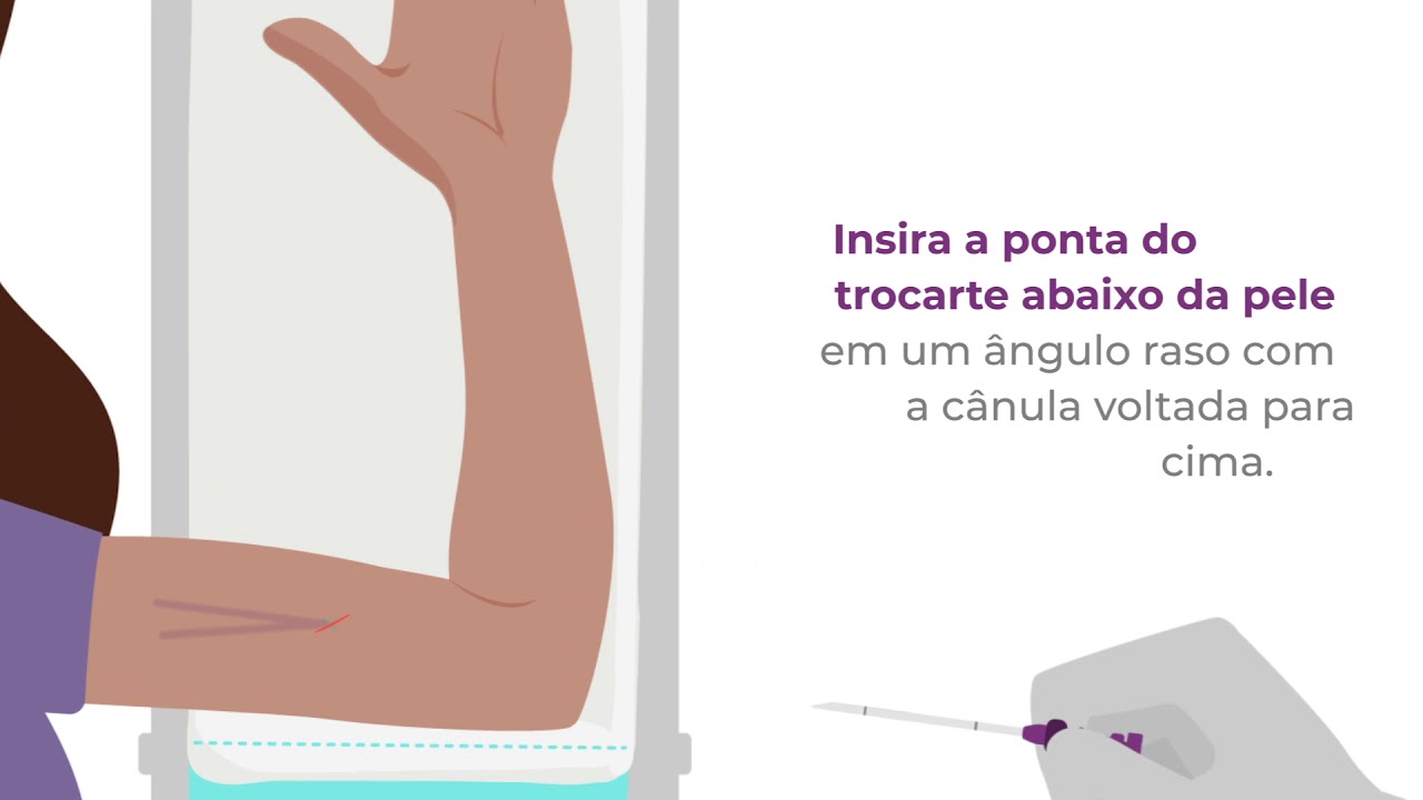 Como inserir o Levoplant™ (video tutorial - Portuguese) - YouTube