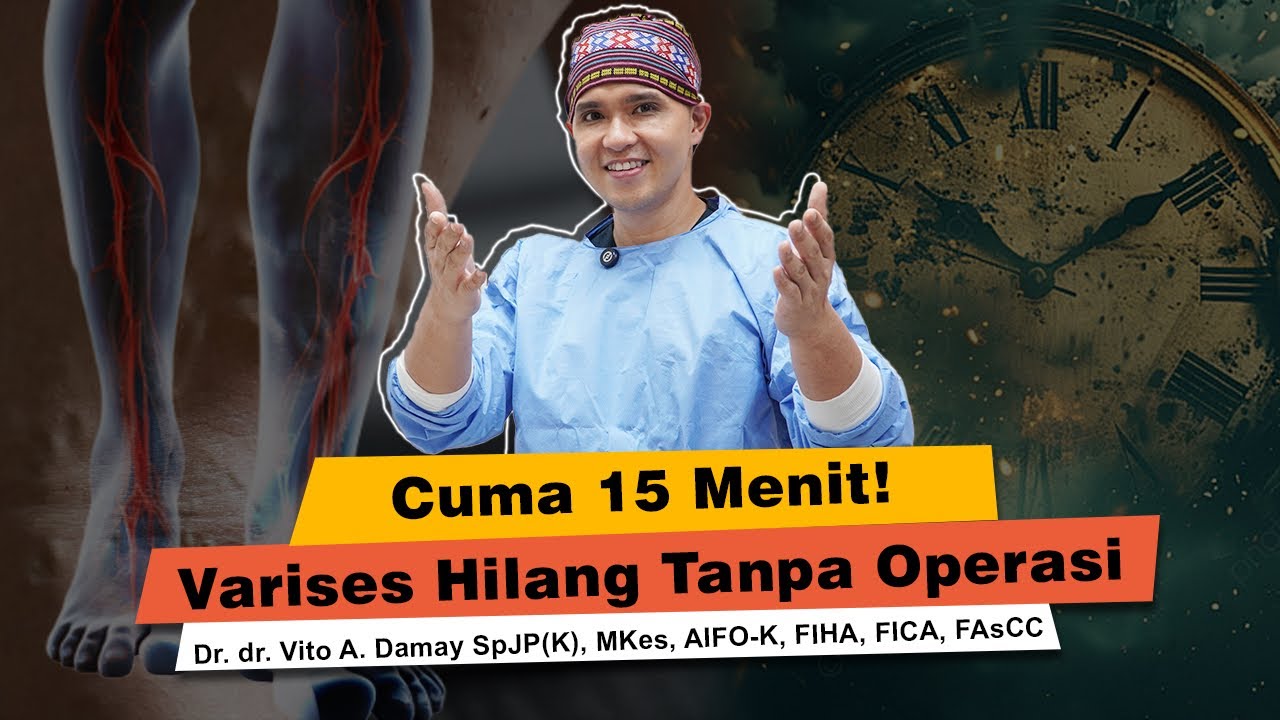 Dr Vito | Varises, Tanda Sirkulasi darah terganggu.Cegah sejak awal ...