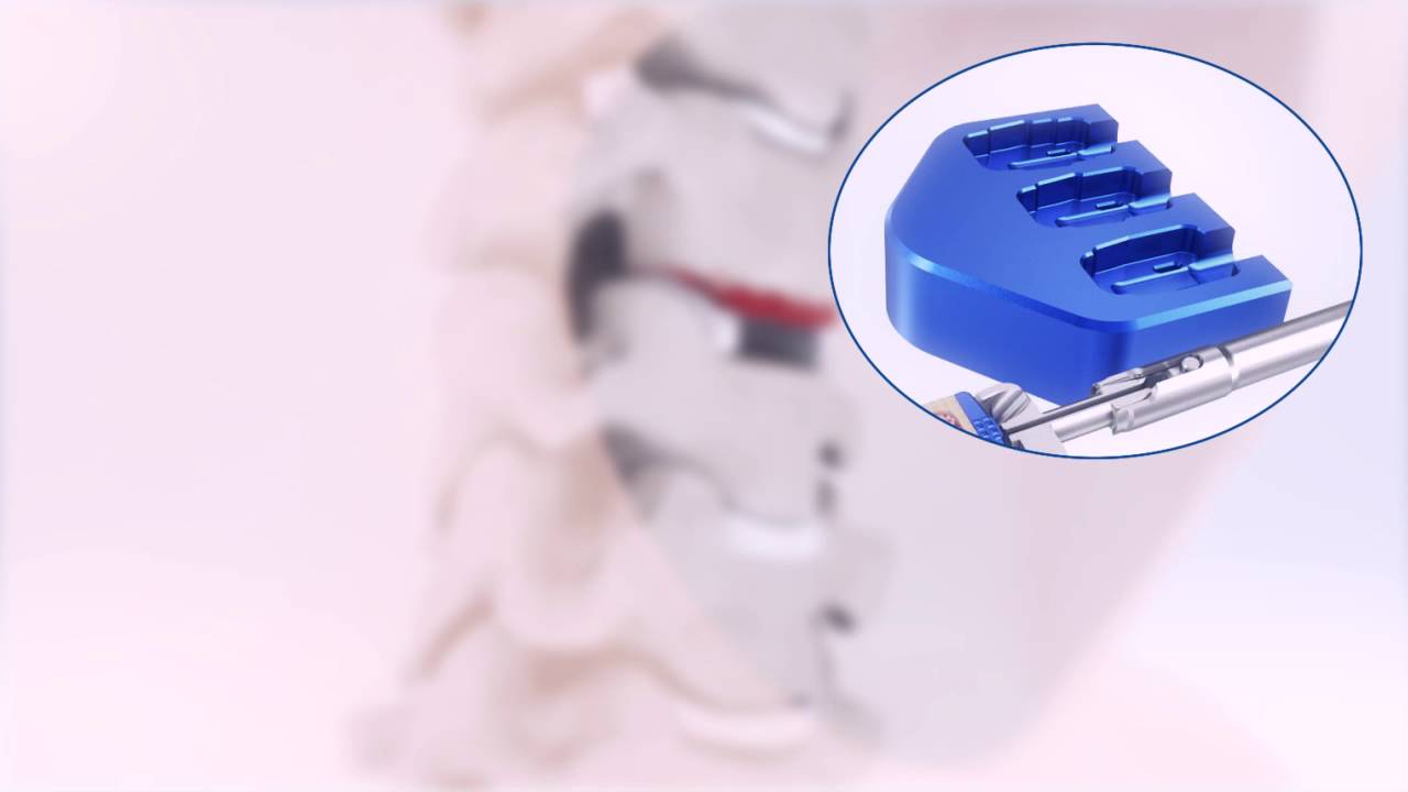 Precision Spine-Vault C ACDF System - YouTube