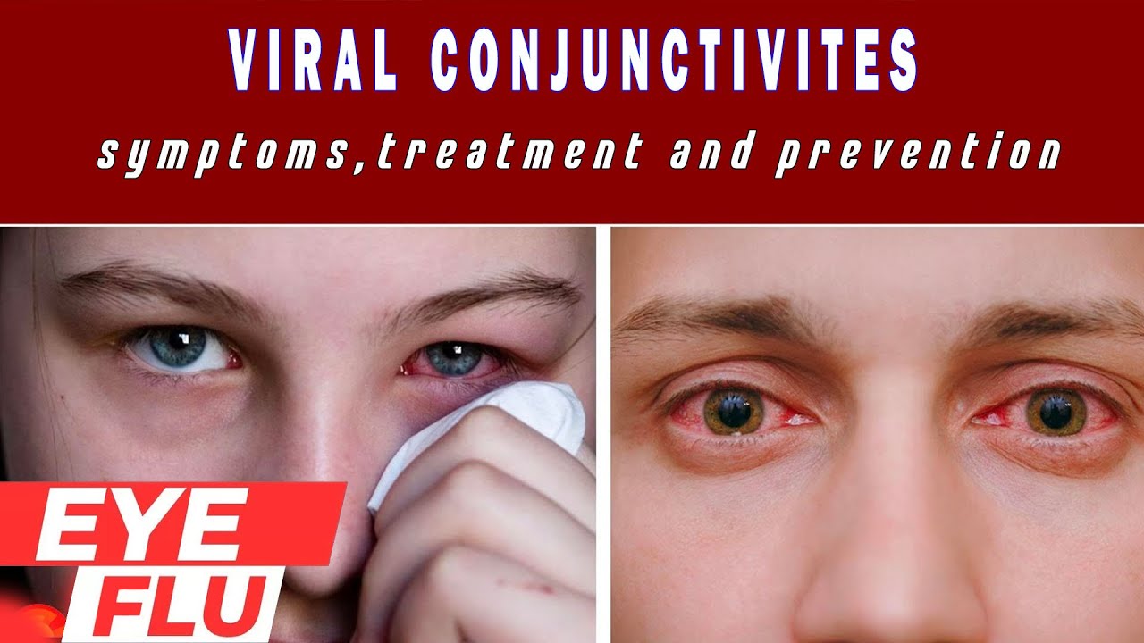 HOW TO TREAT EYE FLU: VIRAL CONJUNCTIVITIS SYMPTOMS, TREATMENT AND ...