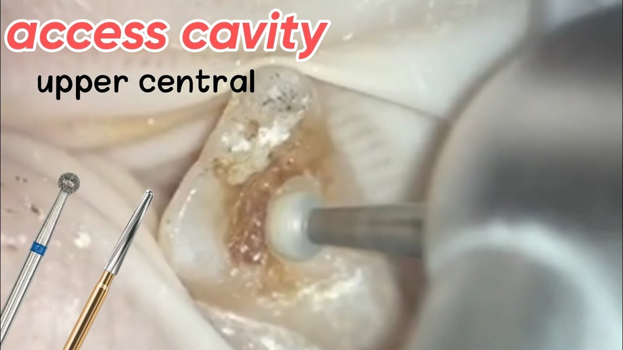 Upper Central Access Cavity preparation - YouTube