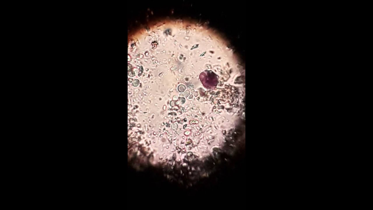 iodine wet mount of stool sample with yeast - YouTube
