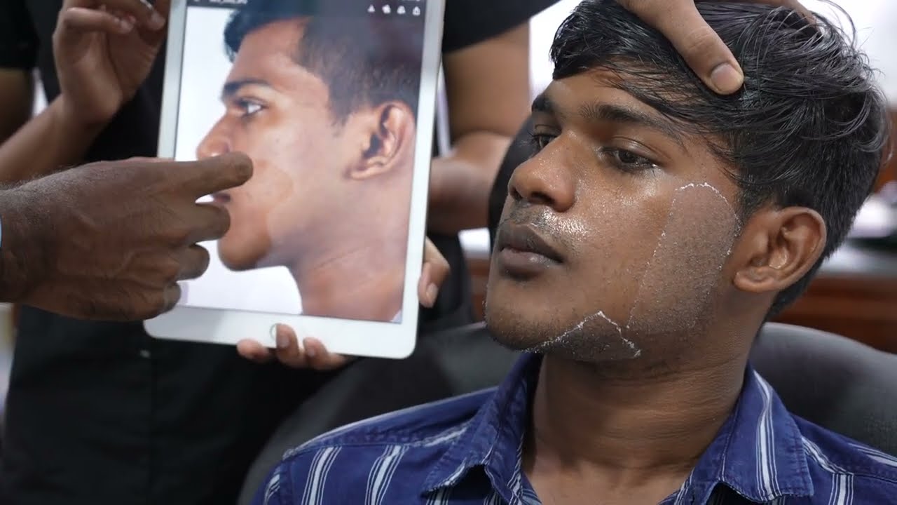 Double Jaw Surgery - Before Surgery and 10 days after Surgery - YouTube