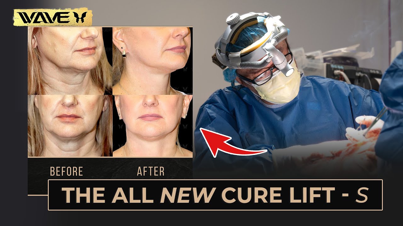 The New and Improved Cure Lift - S | Wave Plastic Surgery - YouTube