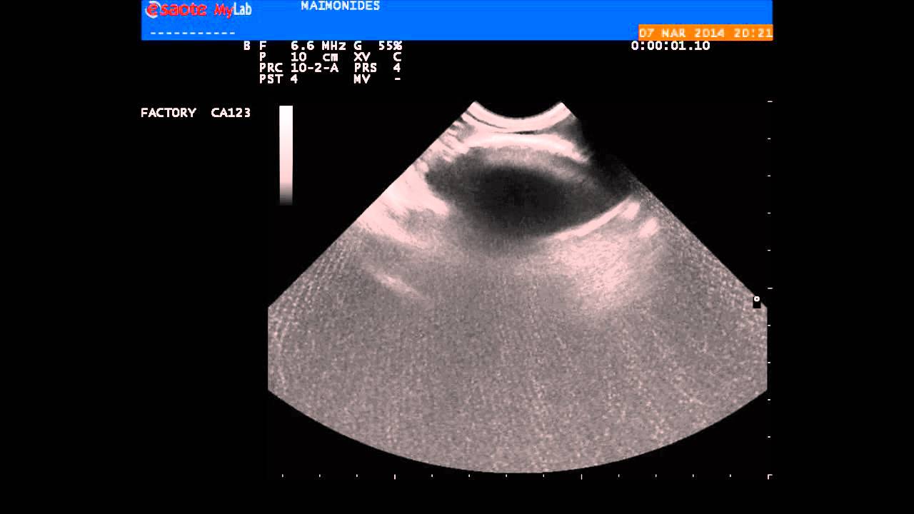 Coprostasia - YouTube