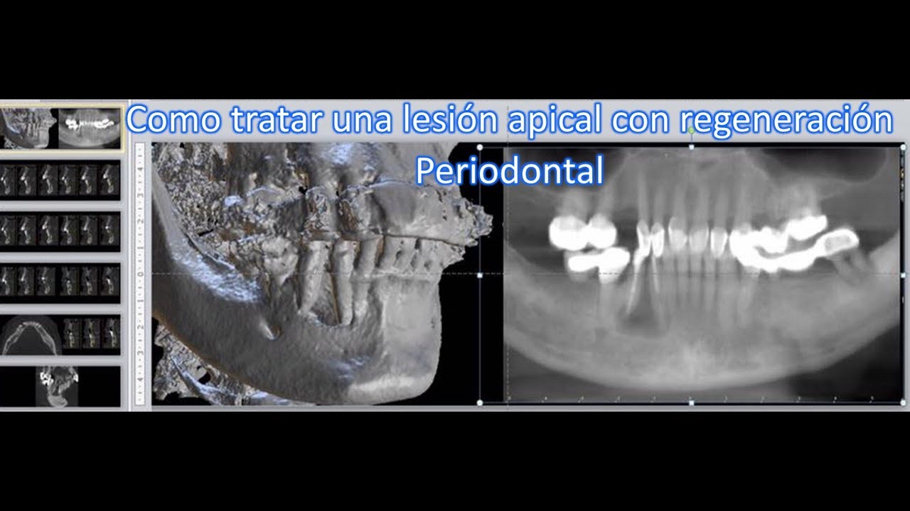 Como tratar una lesión apical con regeneración Periodontal - YouTube