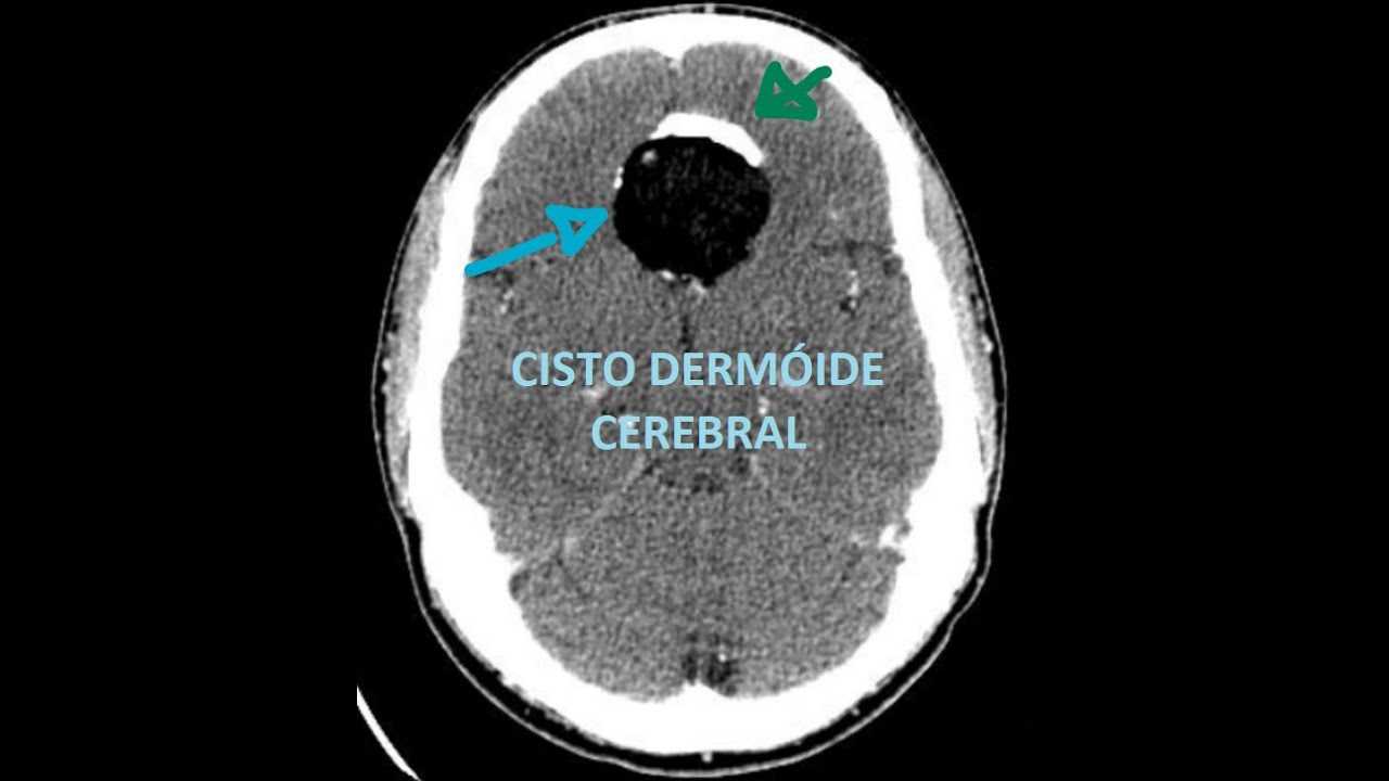 TUMOR DERMÓIDE CEREBRAL - neurocirurgia, (CISTO DERMÓIDE) - YouTube