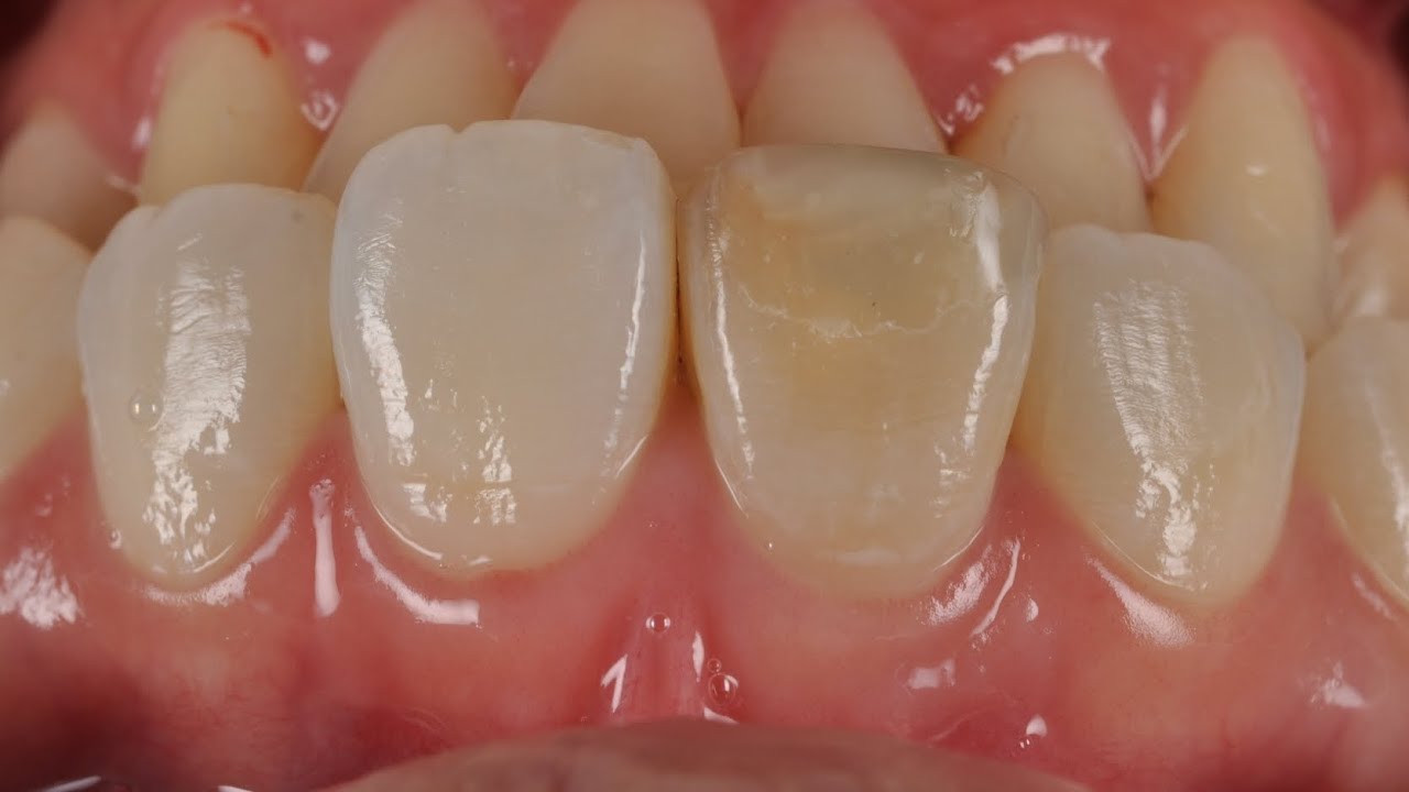 Treatment for dark tooth. (step by step internal bleaching) - YouTube