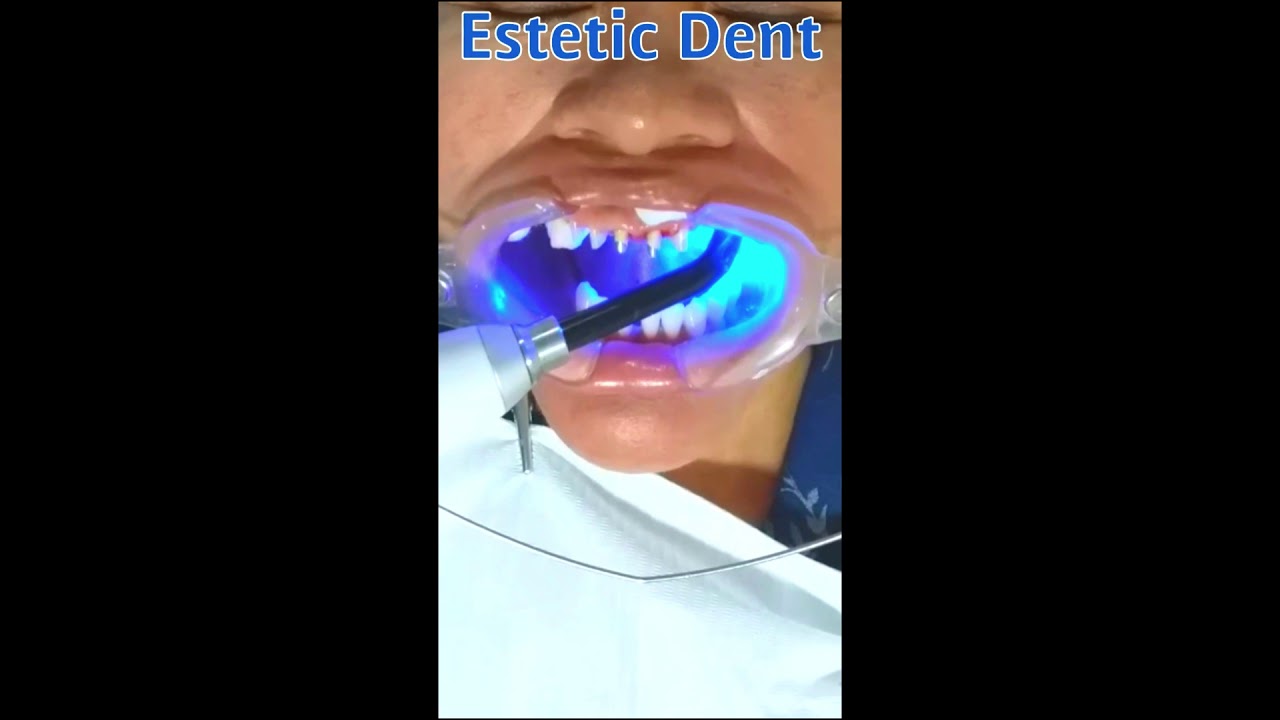 Colocación de retenciones dentales para prótesis parcial estética - YouTube