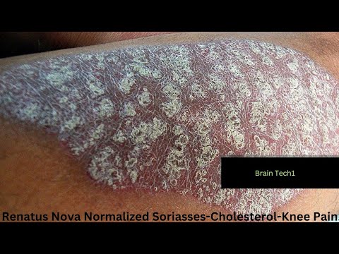 Renatus Nova Normalized Soriasses-Cholesterol-Knee Pain | Brain Tech1 ...