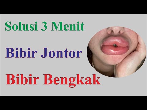 Cara Mengatasi Bibir Jontor , Bibir Bengkak secara Alami