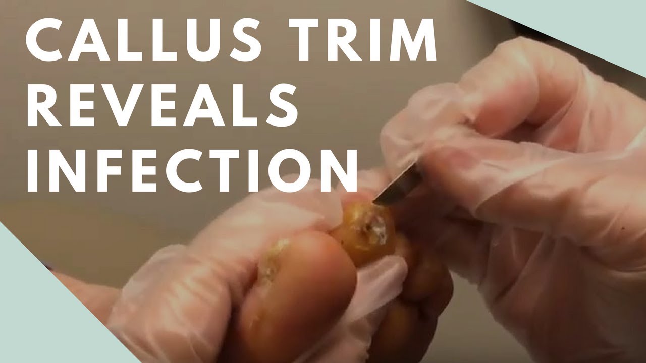 Callus Trim Reveals Infection - YouTube