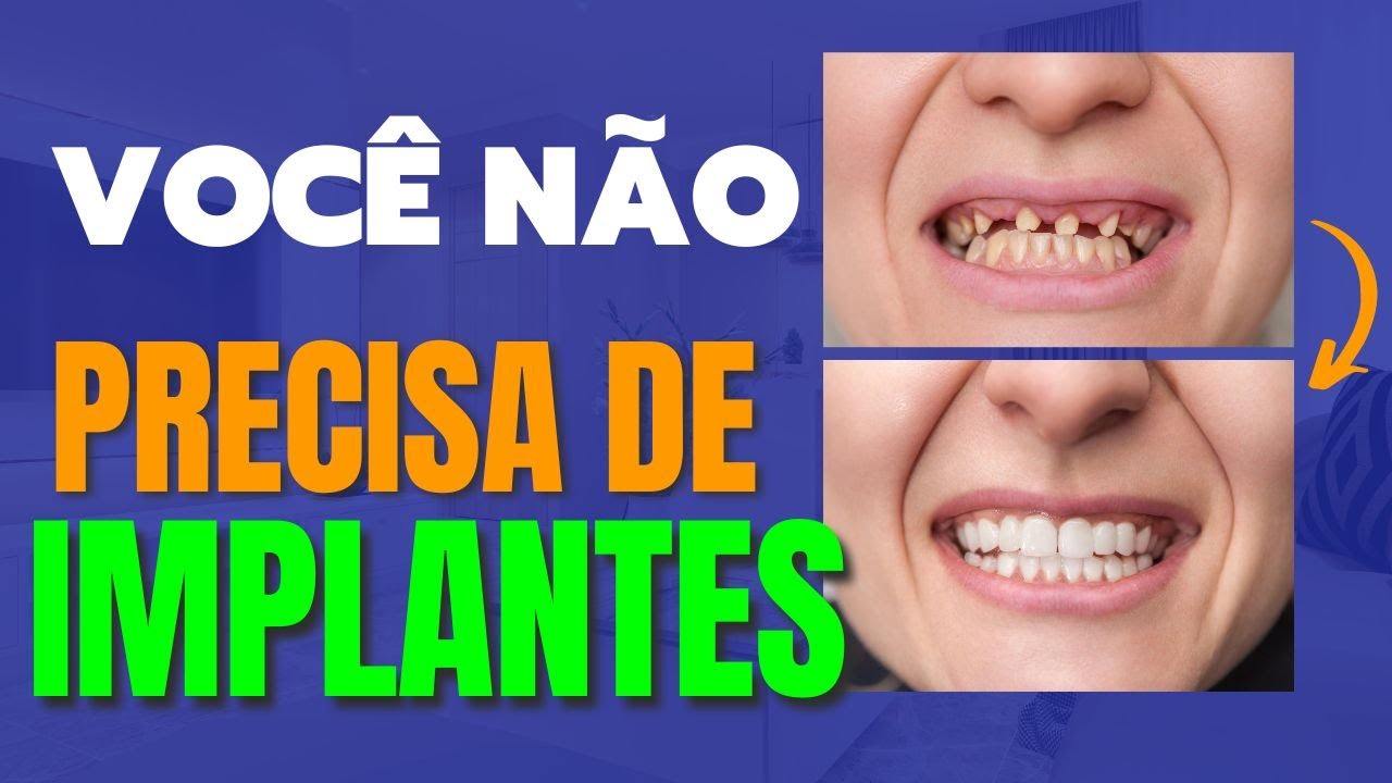 O Implante Dentário é Realmente Necessário? Descubra o Segredo para uma ...