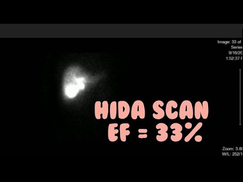 HIDA scan EF medical results imaging - YouTube