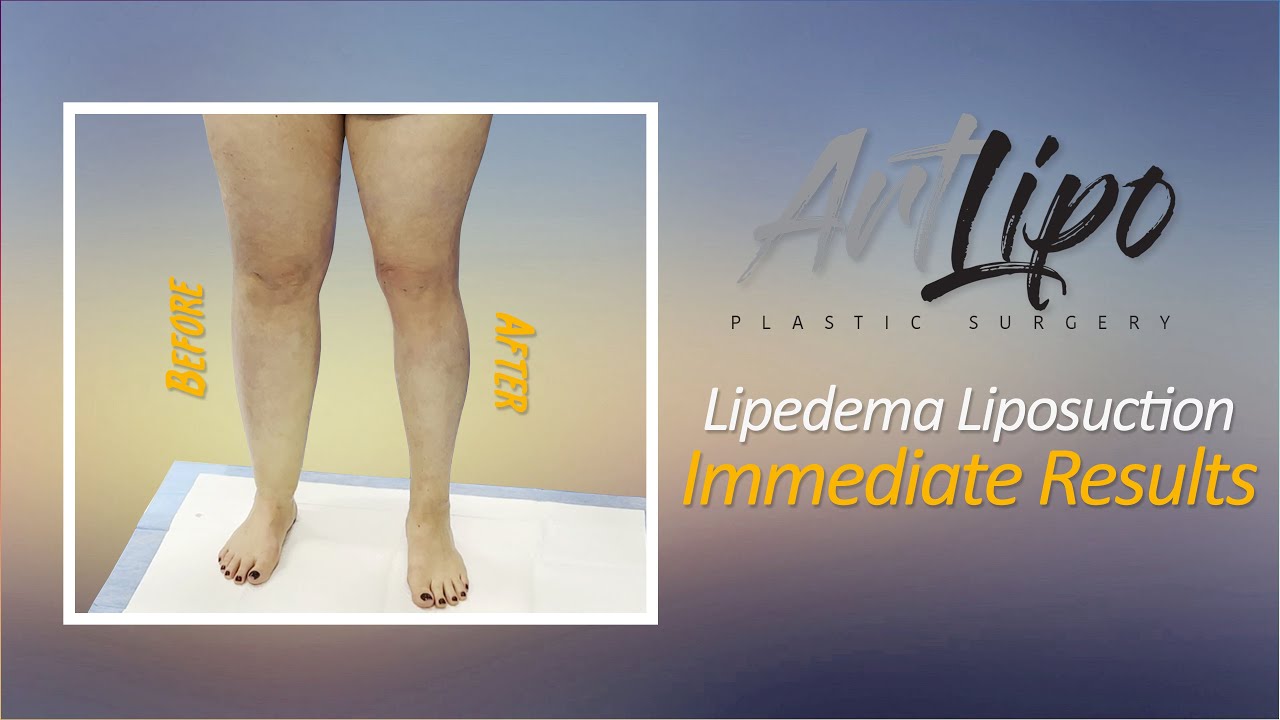 Cankles & Knees Liposuction | Lipedema Legs | Lipo 360° | Expert Dr ...