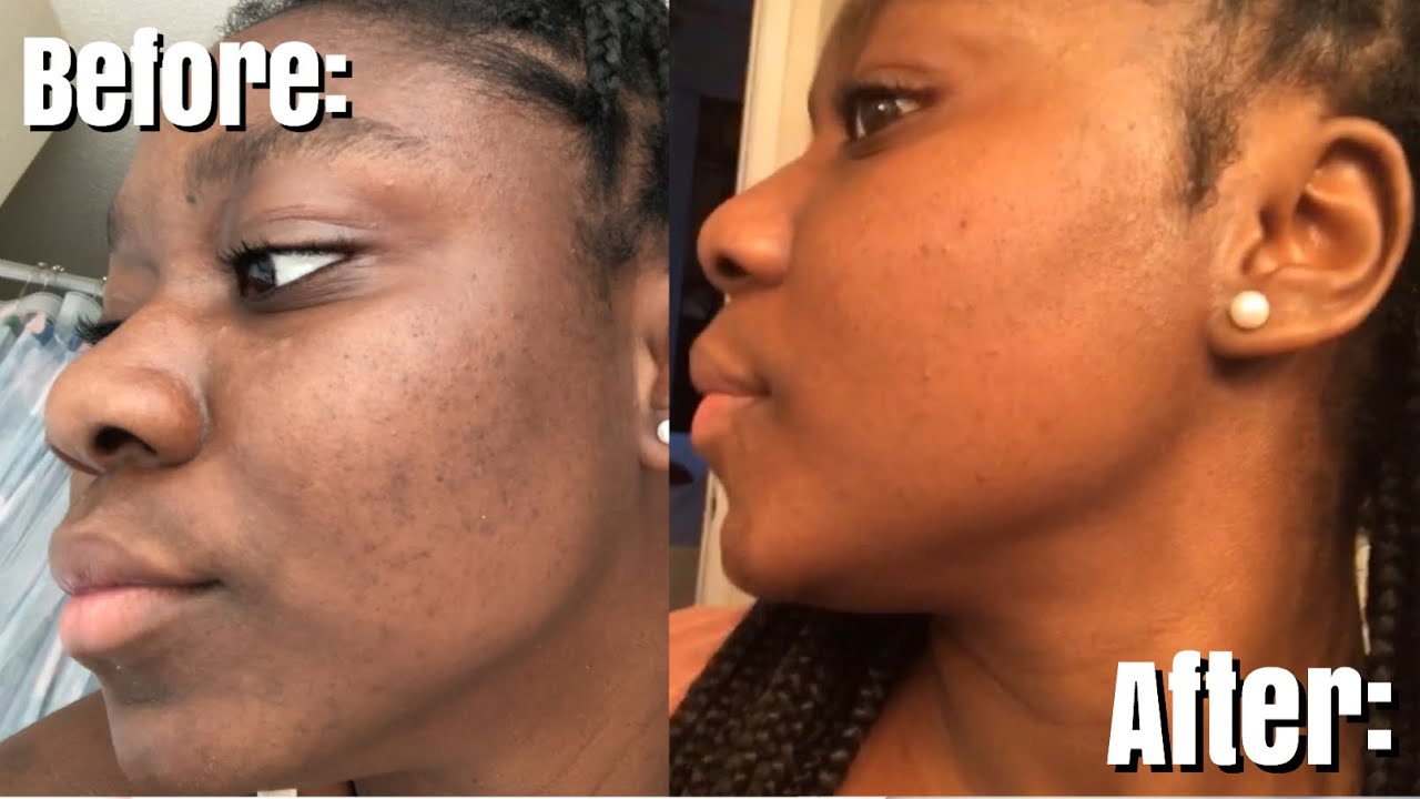 HOW TO GET RID OF HYPERPIGMENTATION & DARK MARKS | Jay Shant’e - YouTube