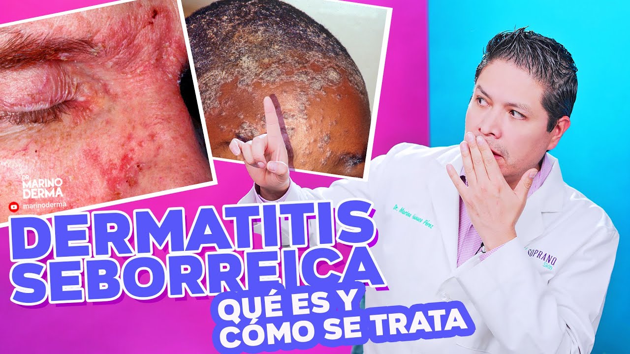 DERMATITIS SEBORREICA. ¿QUE ES Y COMO SE TRATA?. Tips de un dermatologo ...