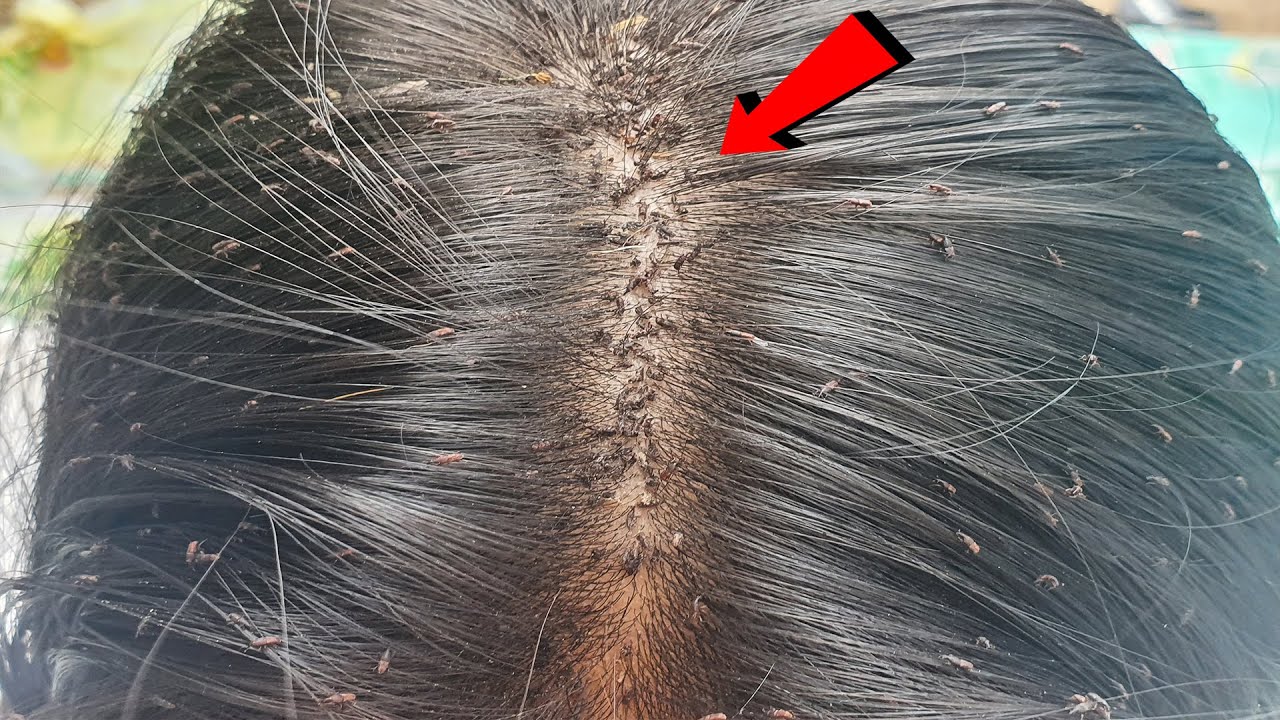 Giant lice combing - Extremely damaged long hair - YouTube