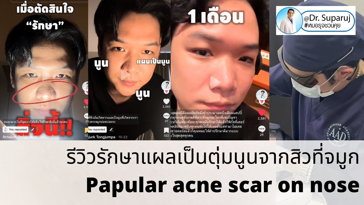 Papular Acne Scar On Nose YouTube papular-acne-scar-on-nose-youtube