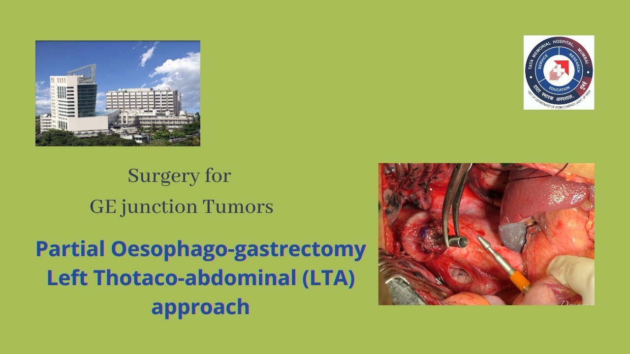 Partial oesophago-gastrectomy: Left Thoraco-abdominal approach (LTA ...