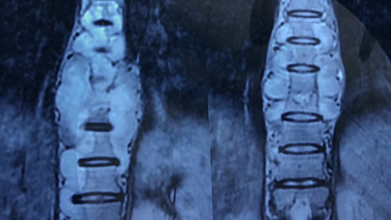 D8/9 kochs Spine - Potts spine- cold abscess drainage with ...