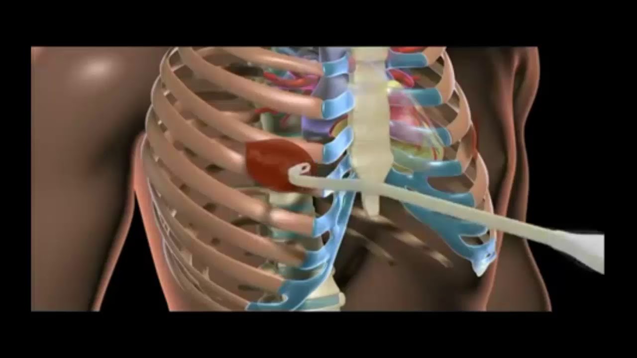 Malformaciones del Esternon - YouTube