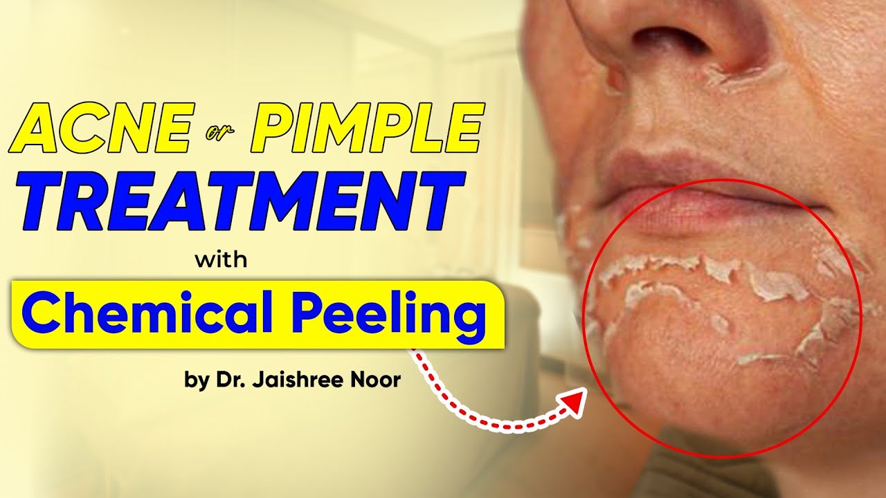 Peeling Treatments for Acne: Procedure and Post-Care Tips | by Dr ...