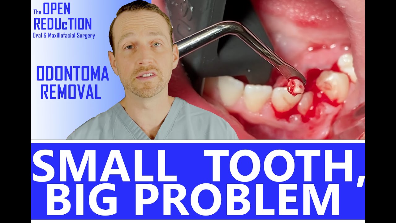 SMALL TOOTH, LARGE PROBLEM | Odontoma Removal | Supernumerary Tooth ...