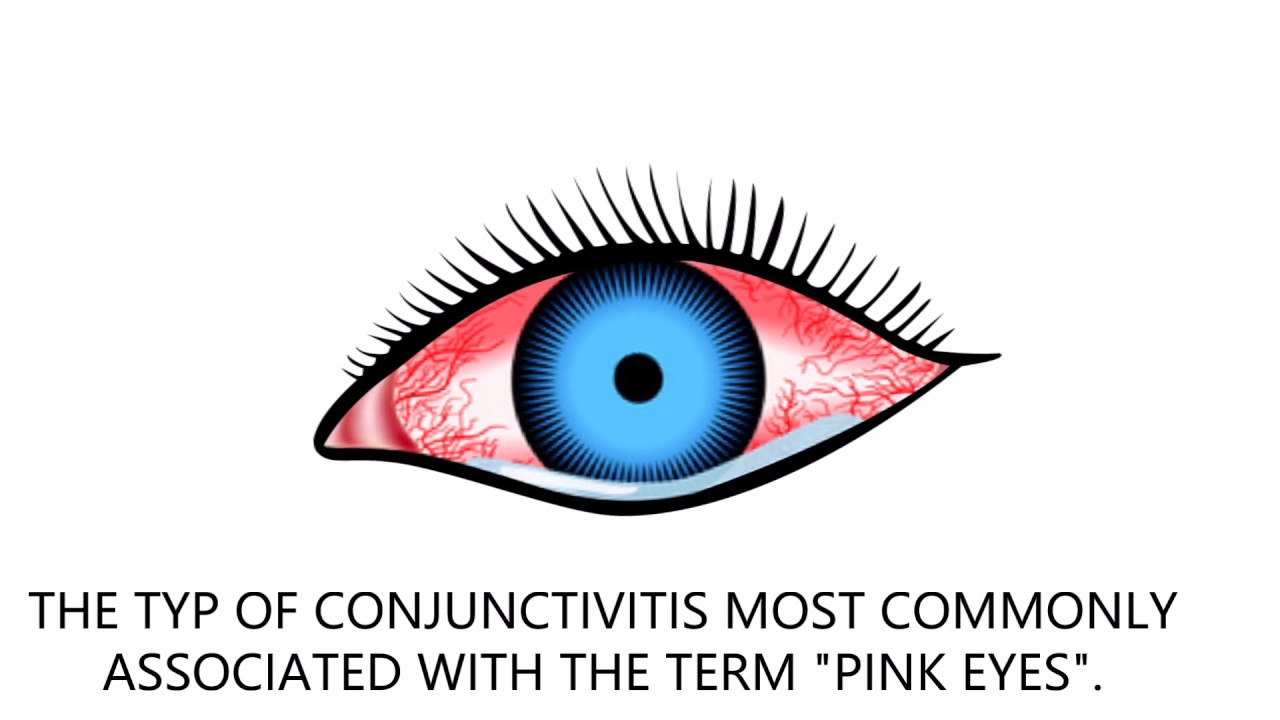 Types Of Conjunctivitis - YouTube